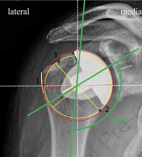 Shoulder Arthritis Joint Replacement Rotator Cuff Tears Stemless