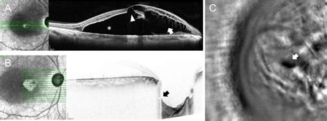 Case 4 A Sd Oct Scan Showing Macular Retinoschisis Arrow