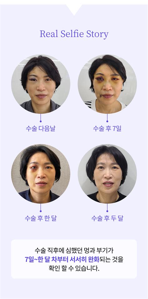 리프팅하면 리팅성형외과