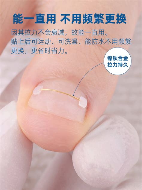 내성발톱교정기 Qu Ping 네일 그루브 임베디드 니켈 티타늄 합금 견인 와이어 교정기 패 티몬