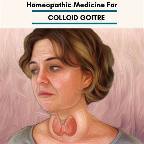 A Colloid Nodular Goiter Occurs When Acute Homoeo Clinic