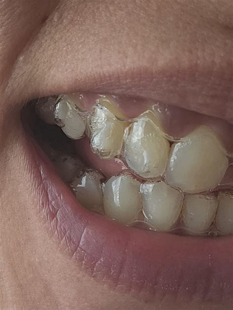 Gaps Rinvisalign