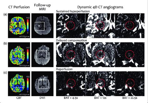 Representative Examples Of Each Of The Three Commonest Perfusion