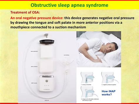Obstructive Sleep Apnea Syndrome Pdf