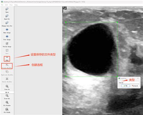 基于yolov8深度学习的医学影像甲状腺结节病症检测诊断研究与实现 pyqt5界面 数据集 训练代码 基于深度学习的甲状腺结节检测系统 csdn博客