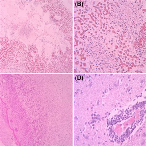 A The Wall Of The Lung Was Hyperemic Cellulose Exudates Were In The