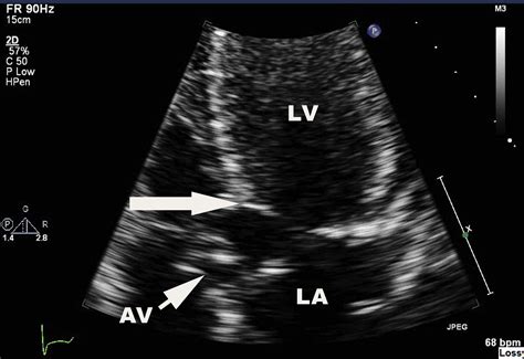 Subaortic Membrane And Hypertrophic Obstructive Cardiomyopathy In The