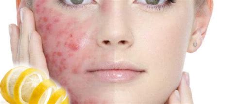 Лікування розацеа в Києві, ціна, відгуки - Derm.Com