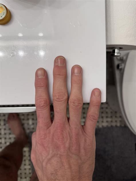 Ana Pattern Question Rscleroderma