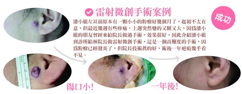 文心極緻皮膚科診所靜脈曲張微創手術 文心極緻皮膚科診所｜健保粉瘤｜脂肪瘤｜青春痘｜靜脈曲張｜雷射｜除毛｜整形手術 Facebook