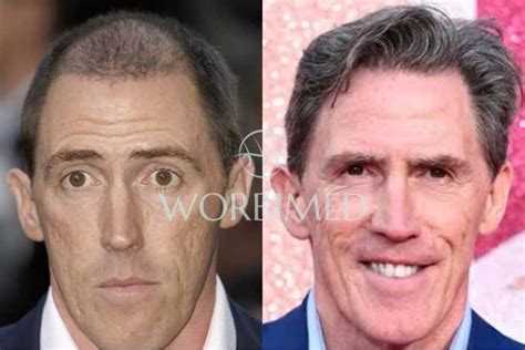 Rob Brydon Hair Transplant L Before And After