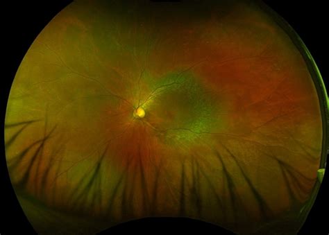 Rod Cone Dystrophy Retina Image Bank
