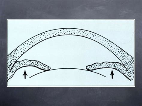 Acute Eye Conditions Glaucomappt