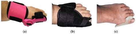 Hallux Valgus