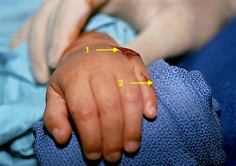 Metacarpal Synostosis Hand Surgery Resource