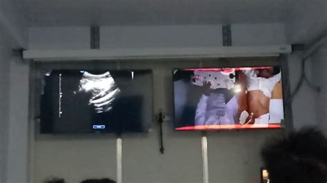 SA ruột thừa YouTube