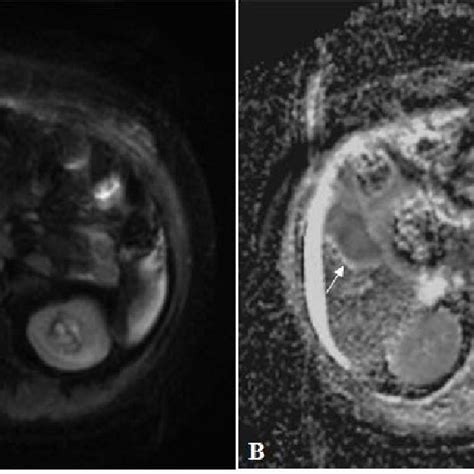 A Mri Diffusion Sequence In Axial Plan With B Value Of 200