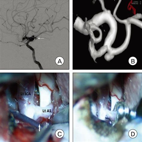 Pdf Management Of Aneurysms Of The Proximal A1 Segment Of The Anterior Cerebral Artery