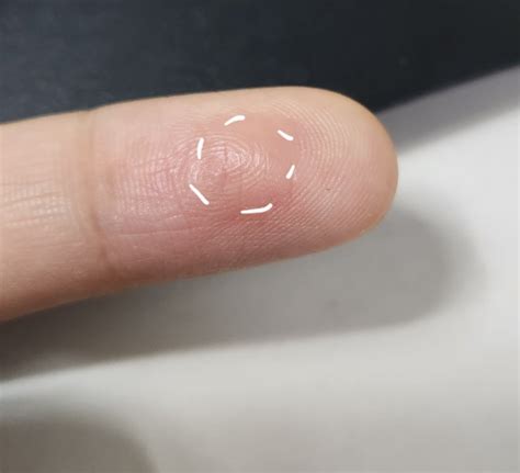 검지손가락 지문쪽이 감각이 둔해요ㅠㅠ 지식in