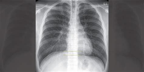آموزش خواندن گرافی قفسه‌ی سینه Cxr بخش پنجم وب سایت دکتر مجری