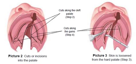 Cleft Palate Anatomy
