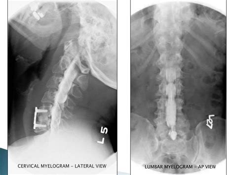 Myelography Pptx
