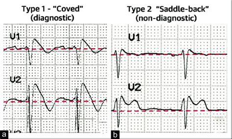 Concave Vs Convex Ecg