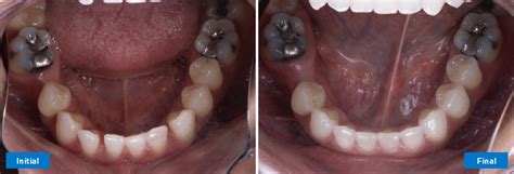 Mild Class 3 Malocclusion Suresmile Case Study Dentsply Sirona Mena