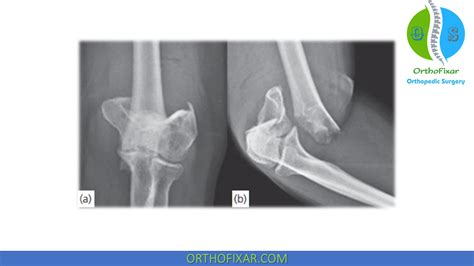 Distal Humerus Fracture