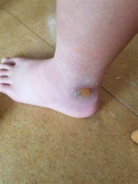 お姉ちゃんの虫刺され ぽつり、ぽつりと。 ～花花ママのブログ～