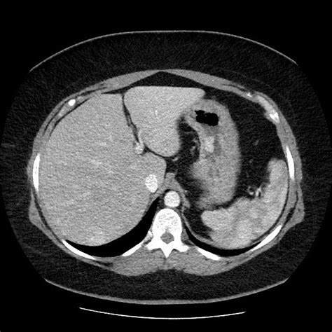 Gastrointestinale Neuroendokrine Tumoren Pacs