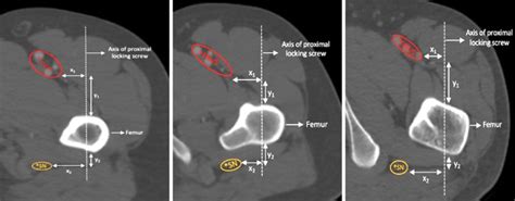 Distances Of Femoral Neurovascular Structures And Sciatic Nerve To The