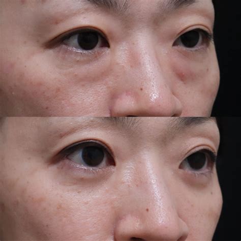 40代女性 脱脂＋脂肪注入 術後3か月 目の下のクマ取りクリニック大阪梅田