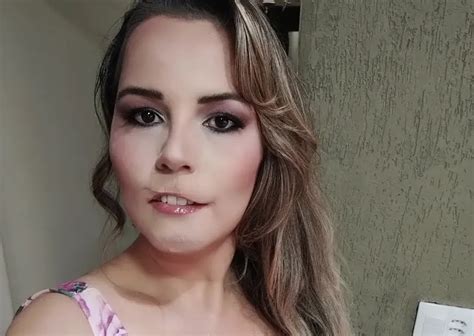 Mulher Perde O Lábio Superior Após Realizar Preenchimento Com Pmma
