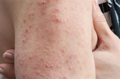 Dengue Fever Rash Face