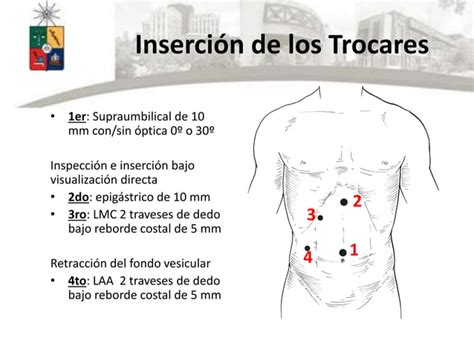 Colecistectomía abierta y vlp PPT