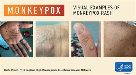 Understanding Monkeypox