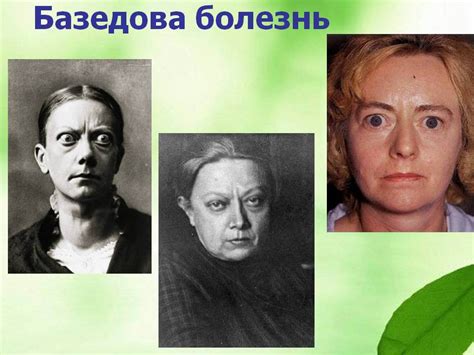Базедова Болезнь У Детей Фото — Картинки фотографии