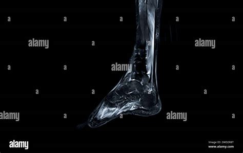 Mri Foot Scan Sagittal View T2 Fat Suppression Technique For Diagnostic