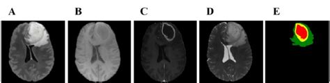 Multimodal Mri Images A Flair B T1 C T1ce D T2 And E