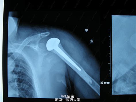 iwatch左肩关节脱位伴大结节撕脱性骨折合并强直性脊柱炎左肩关节脱位伴大结节撕脱性骨折合并强直性脊柱炎 医联