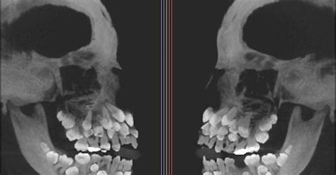 An X Ray Of Someone Who Has Multiple Hyperdontia Imgur