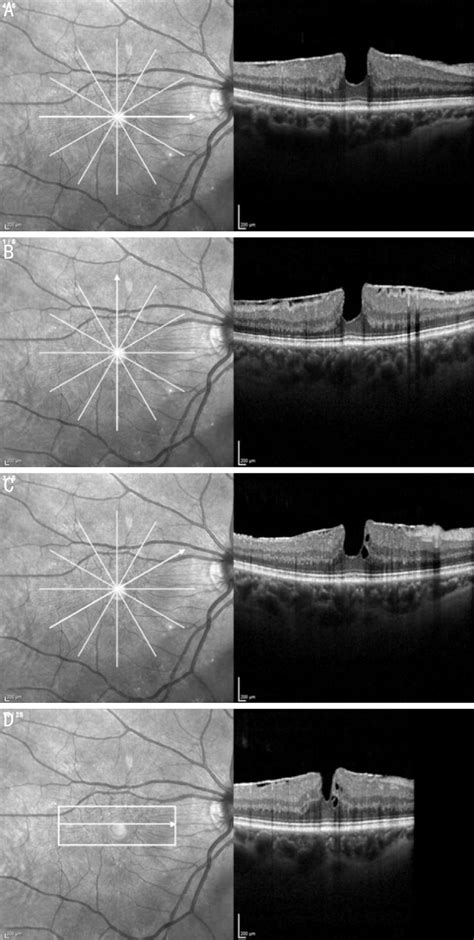 Oct Examination Of The Right Eye The Radial Scan Is Wellcentered The Download Scientific