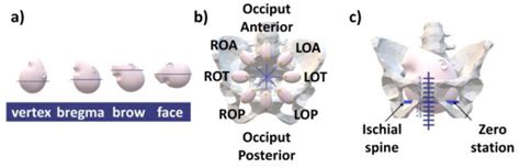 A Fetal Head Presentation The Horizontal Line Indicates The Mothers Download Scientific