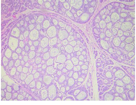 Histopathology Of The Right Submandibular Gland Mass Showing Nodular Download Scientific
