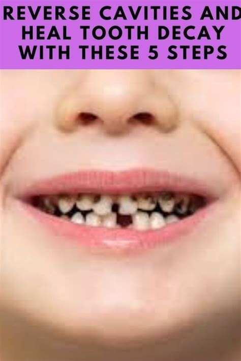 Simple Ways To Naturally Reverse Cavities And Heal Tooth Decaycavities