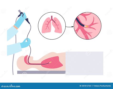 Bronchoscopy Respiratory System Emphysema Endoscopy Human Lung