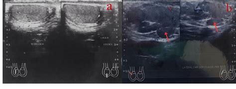 Figure 2 From A Rare Pediatric Scrotal Hemangioma A Case Report And Comprehensive Analysis Of N