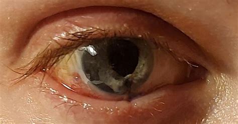 This Is What My Right Eye Looks Like Right Now After The Workplace