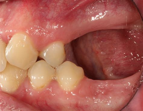 Bone Grafting After Tooth Removal Why When And What To Use Perio